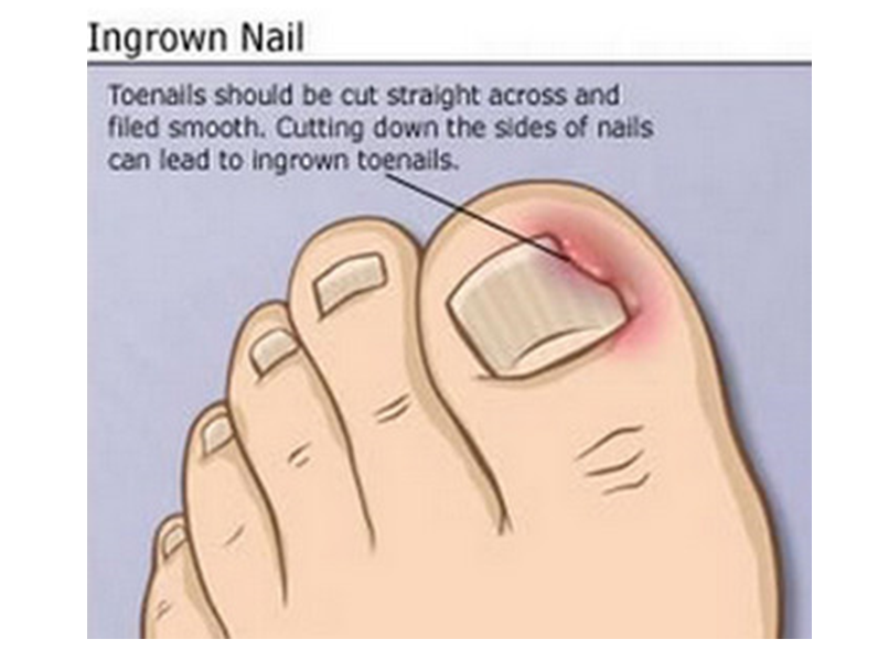 Ingrown Toenails Treated in Fort Myers in Fort Myers & Cape Coral, FL ...
