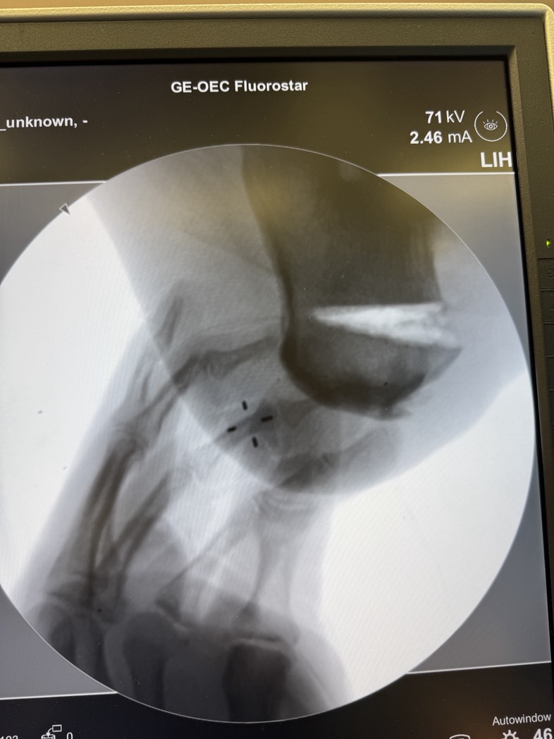 Back of the Heel Pain Treated in Fort Myers in Fort Myers & Cape Coral ...